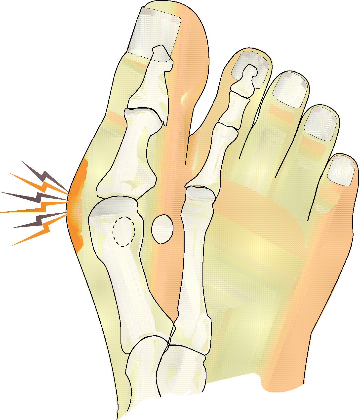 Hallux valgus – vårdriktlinje för primärvården - Region Skåne